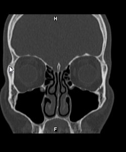 ניתוח סינוסים : FESS – Functional Endoscopic Sinus Surgery - עתיד מדיקל